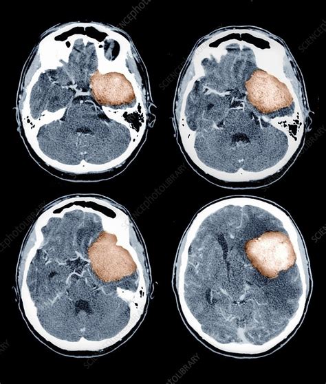 Brain Tumour Ct Scans Stock Image C0269956 Science Photo Library