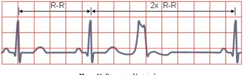 Figure 1 From Classification Of Electrocardiogram Signal Using Support Vector Machine Based On