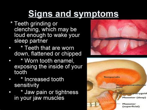 Bruxism