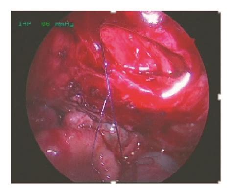 Transverse Incision Of Proximal Duodenum Download Scientific Diagram