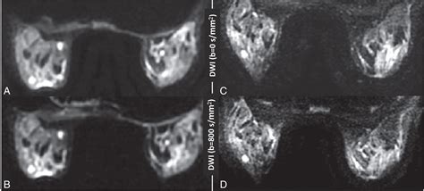 Multiplatform Standardization Of Breast Dwi Protocols Quality Control