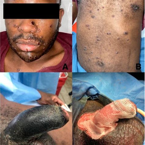 A Umbilicated Papules On The Forehead The Lips And Perioral Region