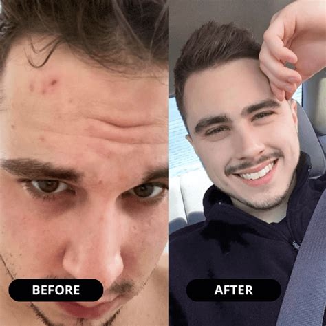 Shield Acne System For Men