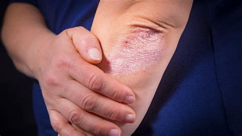 The Heartbreak Of Psoriasis Welcome To Healthaffects Official Website