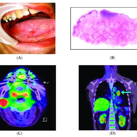 A 60 Year Old Male Patient Underwent Partial Glossectomy For Right Scc