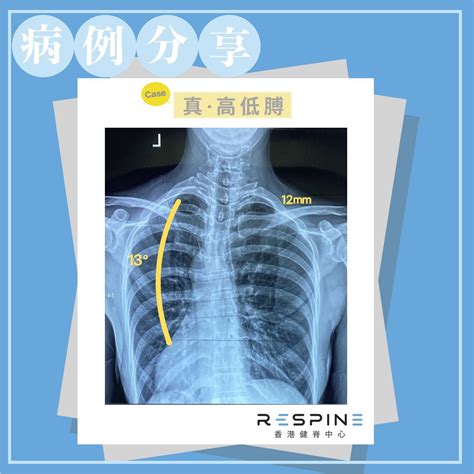 Respine Hk香港健脊中心 銅鑼灣脊醫 👨🏻‍⚕️📋分享病例 究竟痛症循環對脊骨健康影響力多大？ 這位病人痛症纏繞多年，但一直