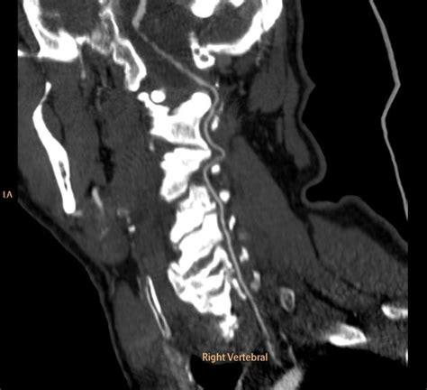 Pica Termination Of Hypoplastic Vertebral Artery Estrich Mobil