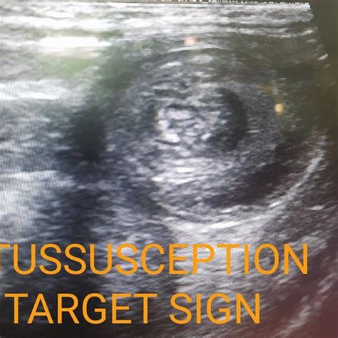 Ultrasound Imaging Showing Loop Within Loop Picture Target Sign