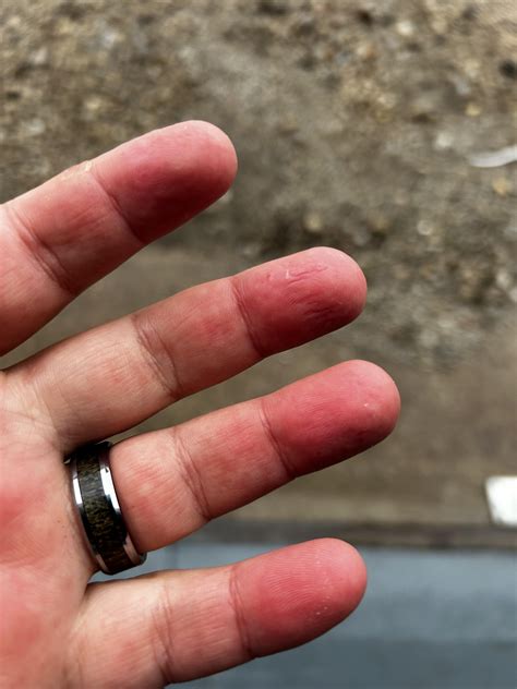 Raynauds R Scleroderma