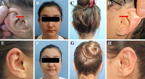 A 35 Year Old Female Patient Operated By Non Incision Otoplasty
