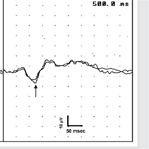 Visual Potentials Vep To Reversal Pattern In Patient 5 Note A Download Scientific Diagram