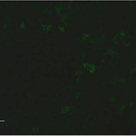 Nmdar Antibodies In Csf Anti N Methyl D Aspartate Receptor Nmdar