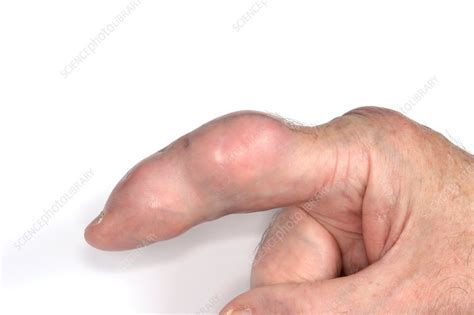 Gout In The Finger Stock Image C Science Photo Library