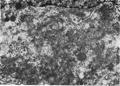 Electron Micrograph Showing Details Of Hyaline In Figure 2 The