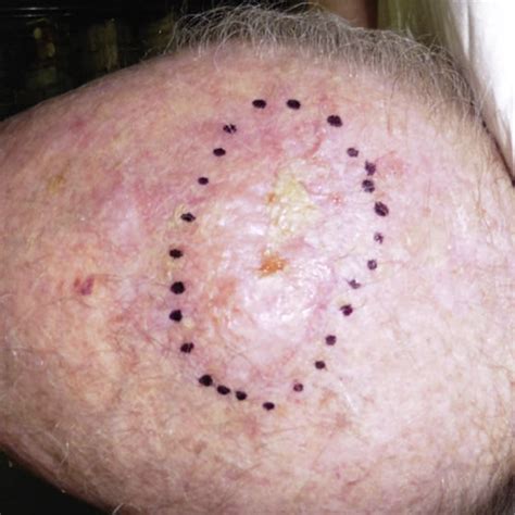 Figure A Sagittal Section Of Spine Magnetic Resonance Imaging Showed Download Scientific