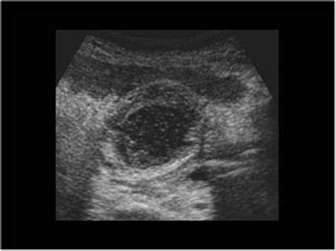 Abdomen And Retroperitoneum 12 Gallbladder And Bile Ducts Case 128 Gallbladder Abscess
