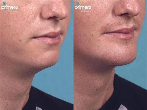 Chin And Cheek Implant Before And After Pictures Case 345 Orlando