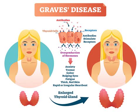 An Endocrinologist Talks About The Thyroid Gland And The Butterfly Effect
