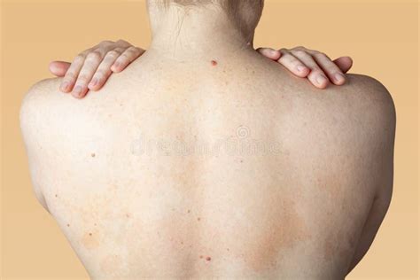Allergic Dermatitis On The Skin Of A Woman`s Back Skin Disease