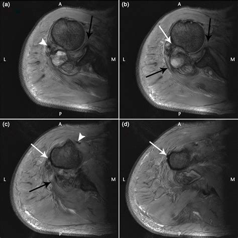 Figure 3 From Posterior Dislocation Of Long Head Of Biceps Tendon