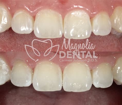 Icon Resin Infiltration In Whiteland In Magnolia Dental