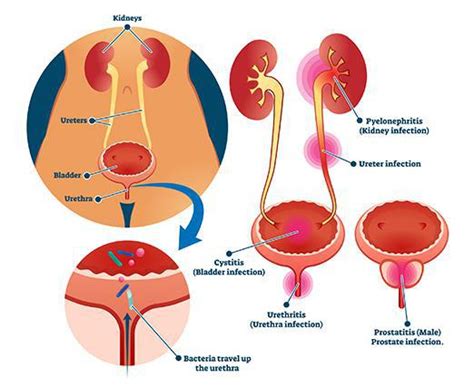 Urinary Tract Infection Urology Associates