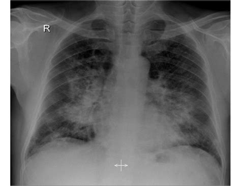 Chest X Ray Showing Bilateral Patchy Infiltration Upon Admission