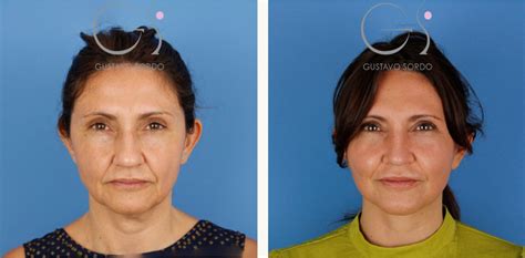 【rinoplastia Antes Y Después Nariz Ancha 2025】50 Casos