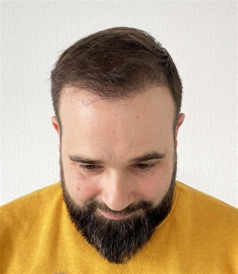 Greffe de Cheveux FUE une Méthode Indolore et Sans Cicatrice