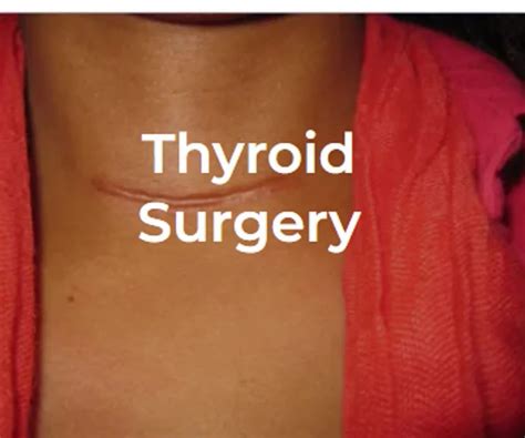Thyroid Surgery In India