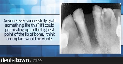 This 75 Year Old Patient Had A Split Root Extracted About 2 Months Ago While On Vacation Has
