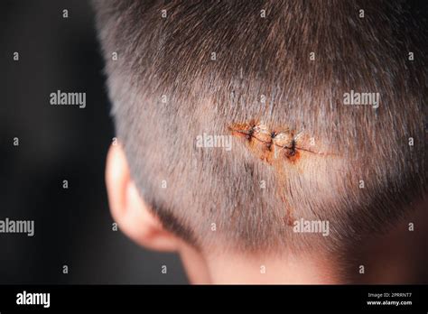 The Lacerated Suture Wound Of Head Which Suture By Nylion Suture About