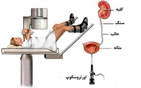 جراحی سنگ کلیه به روش لیزر یا آندوسکوپیک در تهران معرفی بهترین جراح