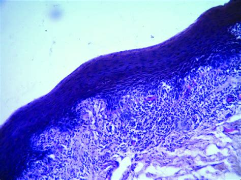Photomicrograph Of Lichen Planus Showing Epithelium With Elongated Rete