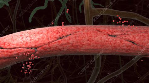 Damaged Brain Capillary Illustration Stock Image C0581679