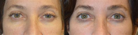 Common Eyelid Problems And Their Fixes