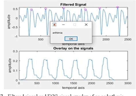 Figure 7 From Multi Layered Cardiac Arrhythmia Detection Using Rmse