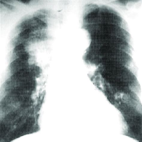 Ct Scan Shows The Nodular Lesion In The Lingular Segment Of The Left