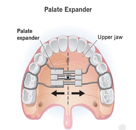 Palatal Expander Top Nova Orthodontics