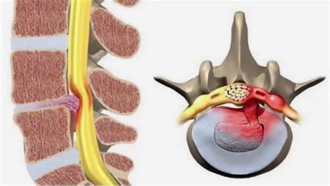 Thoát vị đĩa đệm có thể tự chữa khỏi được không