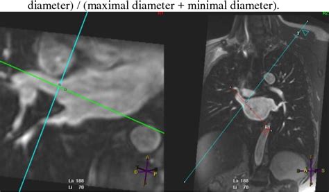 Figure 1 From Predictors Of Atrial Fibrillation Recurrence After Cryoballoon Based Pulmonary