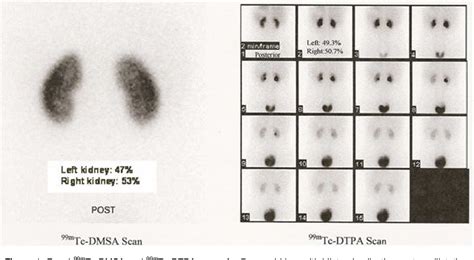 Pdf Comparison Of Split Renal Function Measured By 99m 53 Off