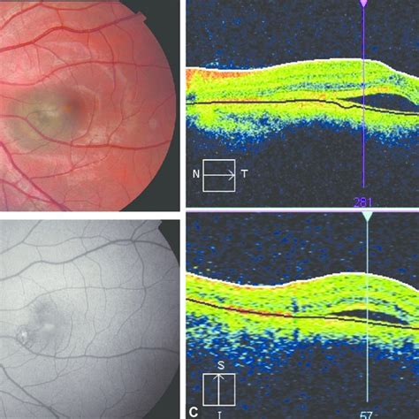 Fundus Autofluorescence And Optical Coherence Tomography Findings In