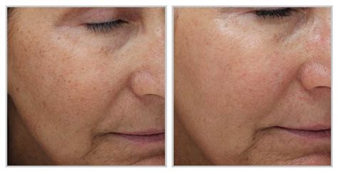 Bbl Treatment Skin Science Clinic