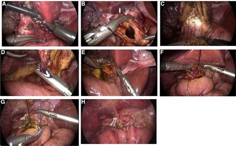 Images Depicting The Steps In Total Choledochal Cyst Resection And
