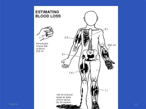 Open Fractures Classification And Management PPT