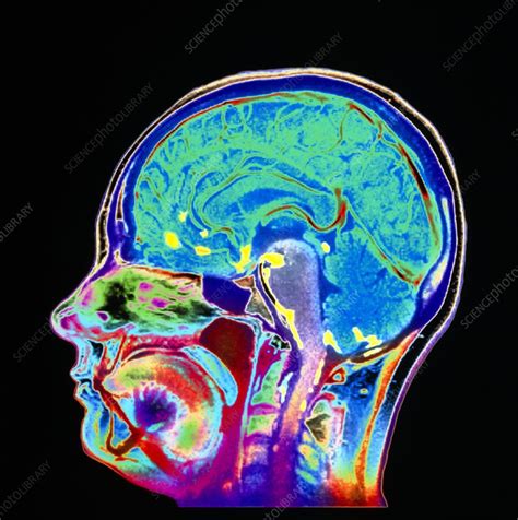 Meningitis Brain Scan Mri Stock Image M2100159 Science Photo