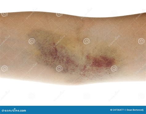 Hematoma Royalty Free Stock Photography Image 24736477