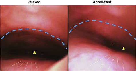 Figure 1 From Airway Obstruction By Transesophageal Echocardiography
