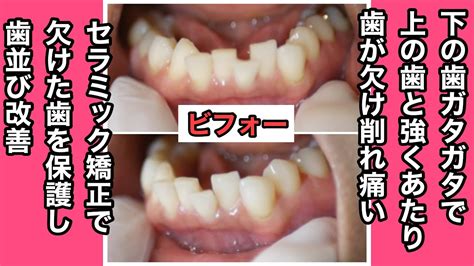 下の歯の叢生 がちゃがちゃ セラミック矯正12 Youtube